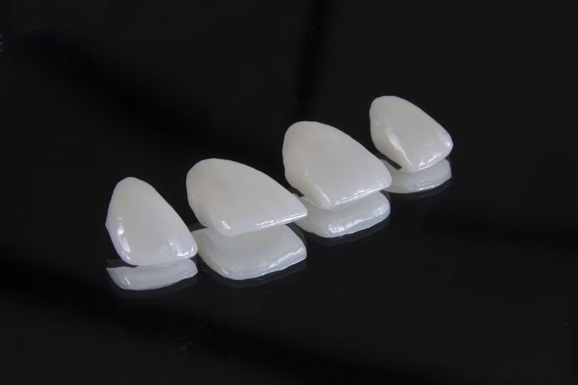 5 Questions to Ask Before Getting Veneers - NewsHuman